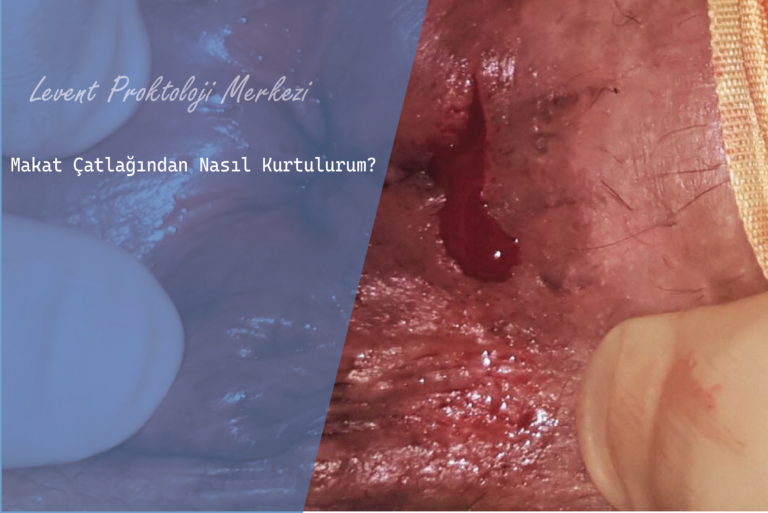 Makat Çatlağından Nasıl Kurtulurum? - Levent Proktoloji Merkezi